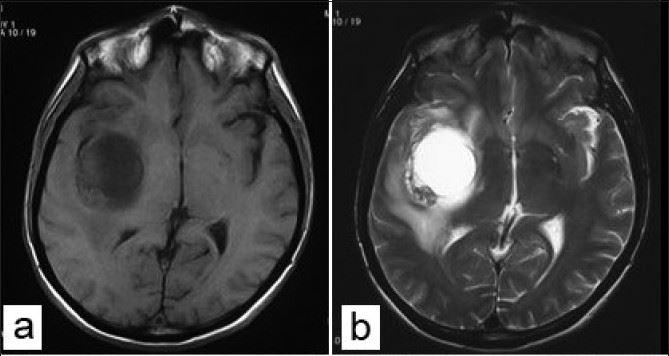 学习MRI时，老师都说 T1 看解剖，T2 看病变，T1、T2 是什么意思？大家怎样理解这句话的？ - 知乎