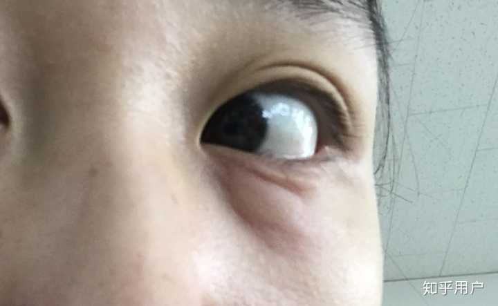 下眼袋突然肿起来是什么回事? 知乎
