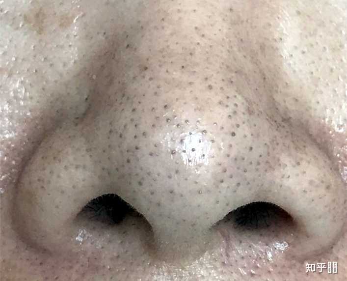 黑头要怎么去掉？ 知乎