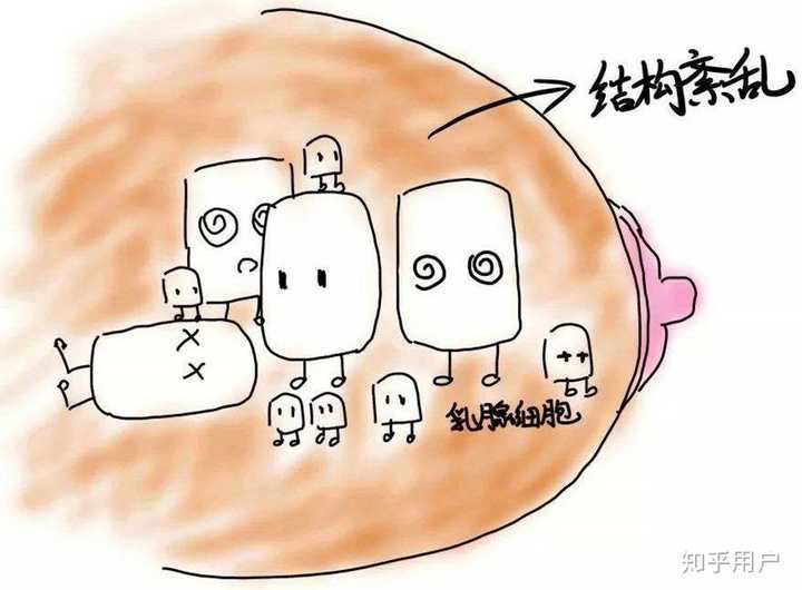 乳腺增生结节严不严重？？ 知乎