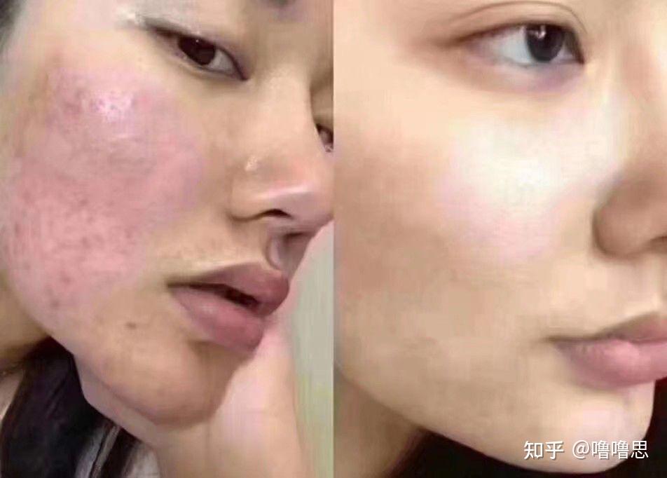 中医祛痘,好好爱自己 知乎