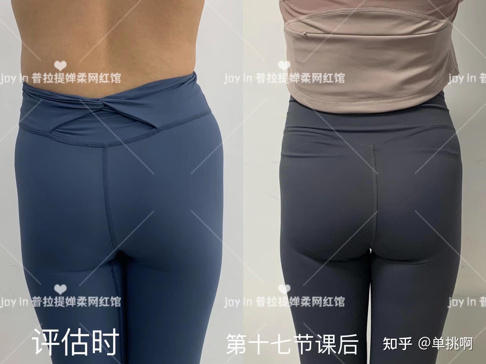 PRI用于脊柱侧弯 - 知乎