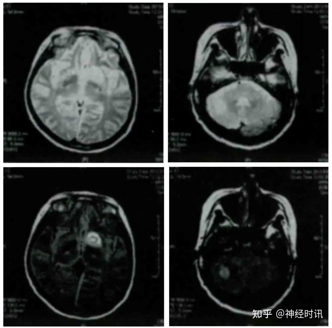 一文读懂化脓性脑膜炎的诊断与治疗 - 知乎
