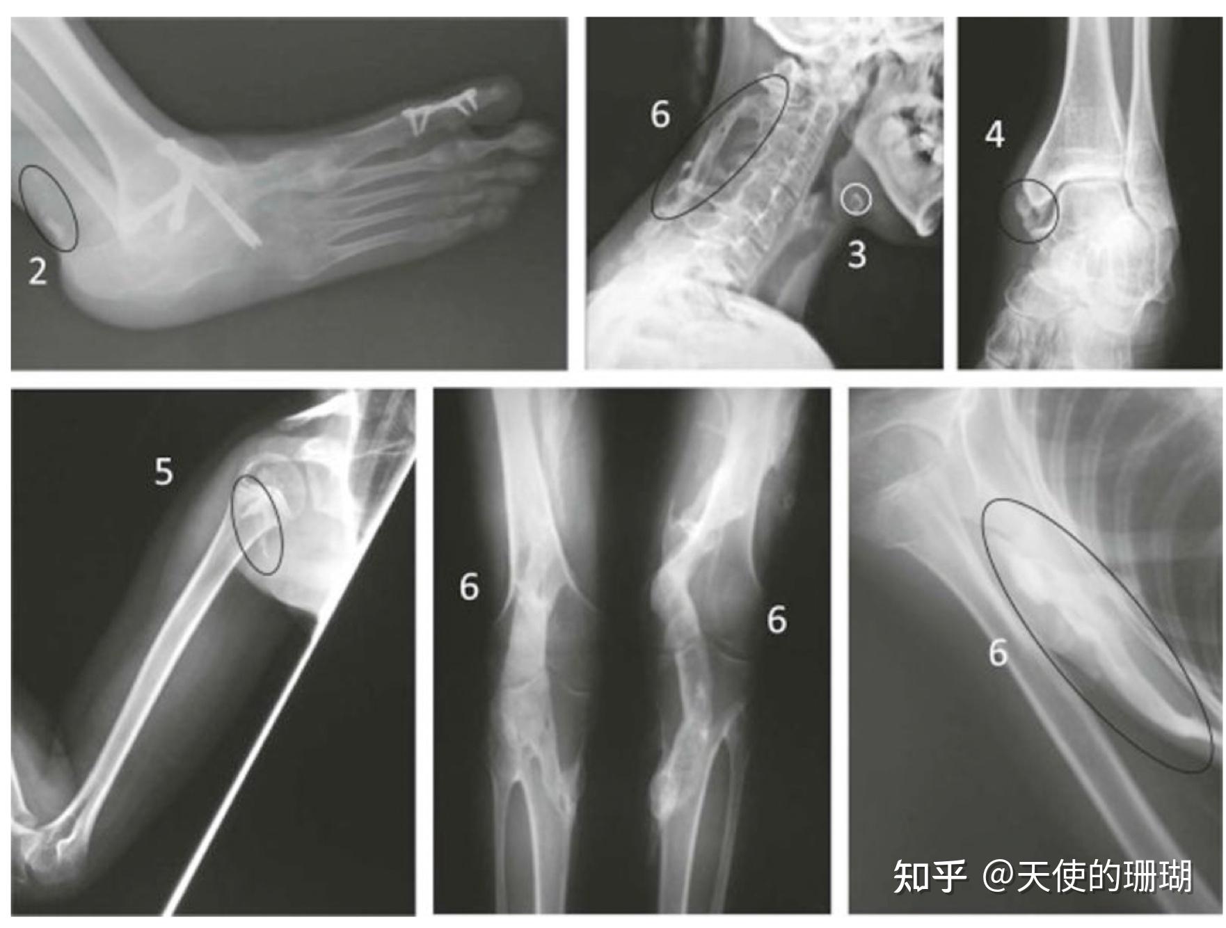 FOP中异位骨(HO)的影像学模拟评估方法 - 知乎