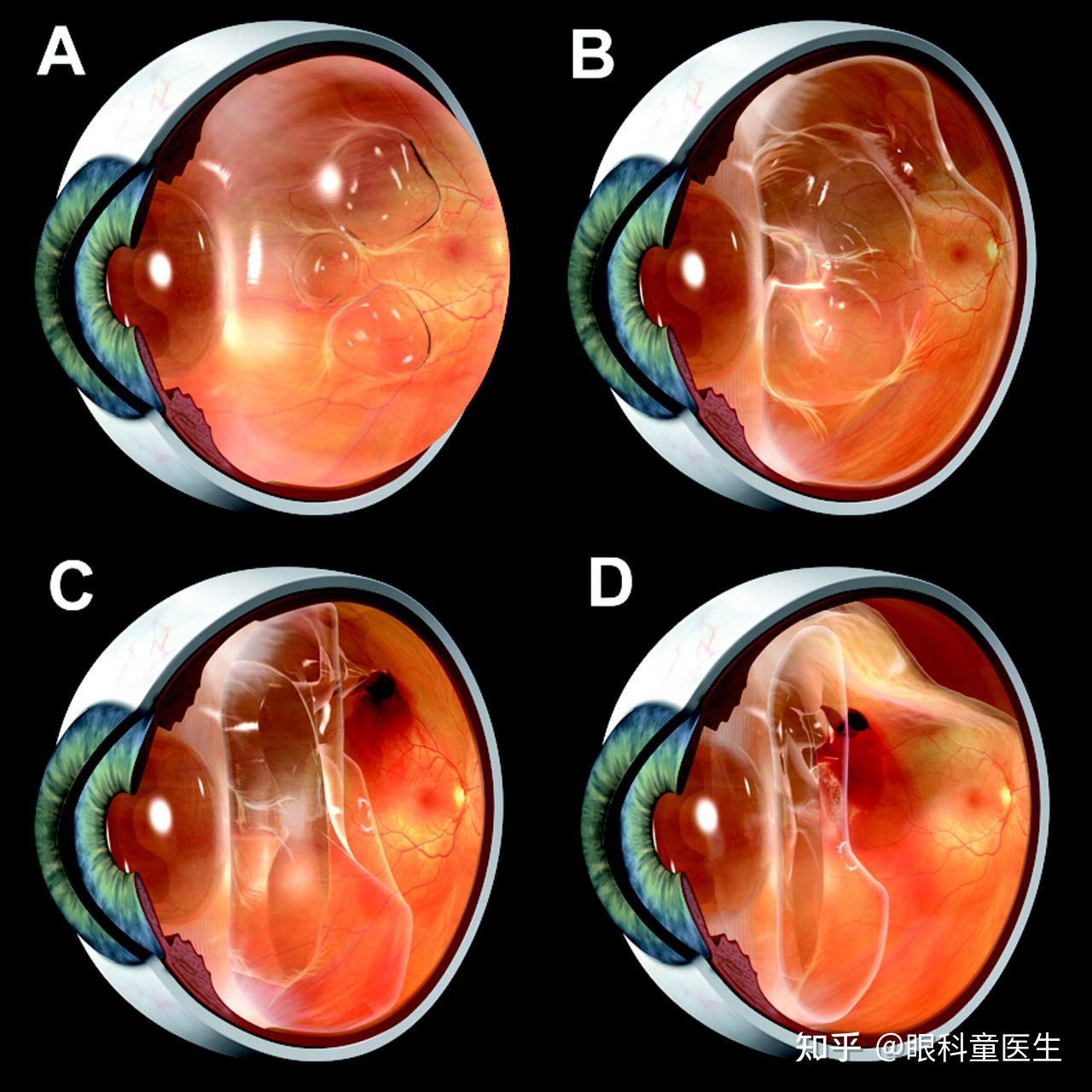 视网膜脱离与劈裂——1、孔源性视网膜脱离 - 知乎