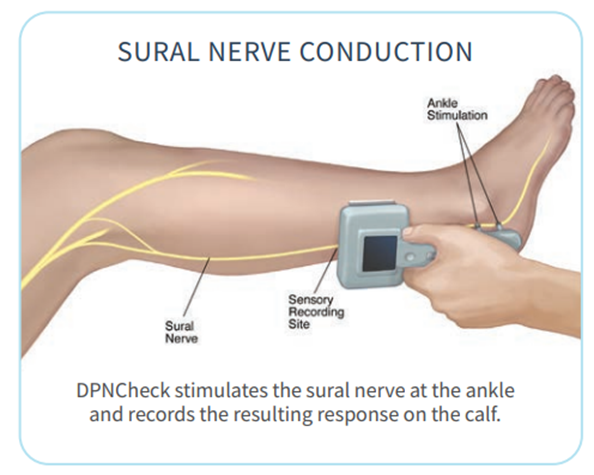 医疗科技评论 | 便携式无创神经传导测量仪DPNCheck用于评估糖尿病周围神经病变 - 知乎