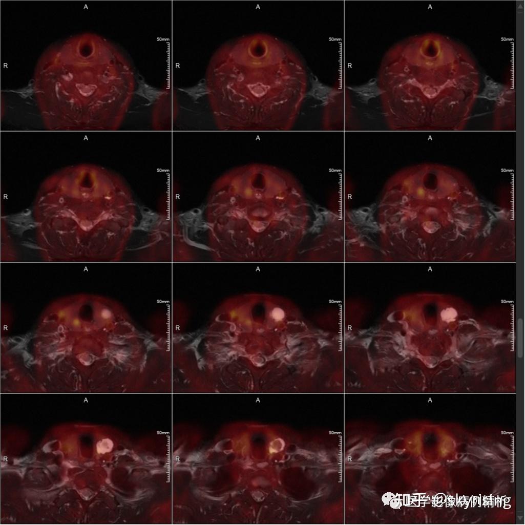 PET/CT+MR多模态检查对于甲状腺病变良恶性鉴别的诊断价值 - 知乎