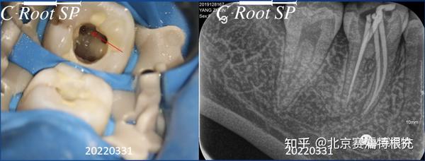 右下第一磨牙5根管再治疗病例 | 杨超医生C-Root SP充填案例 - 知乎
