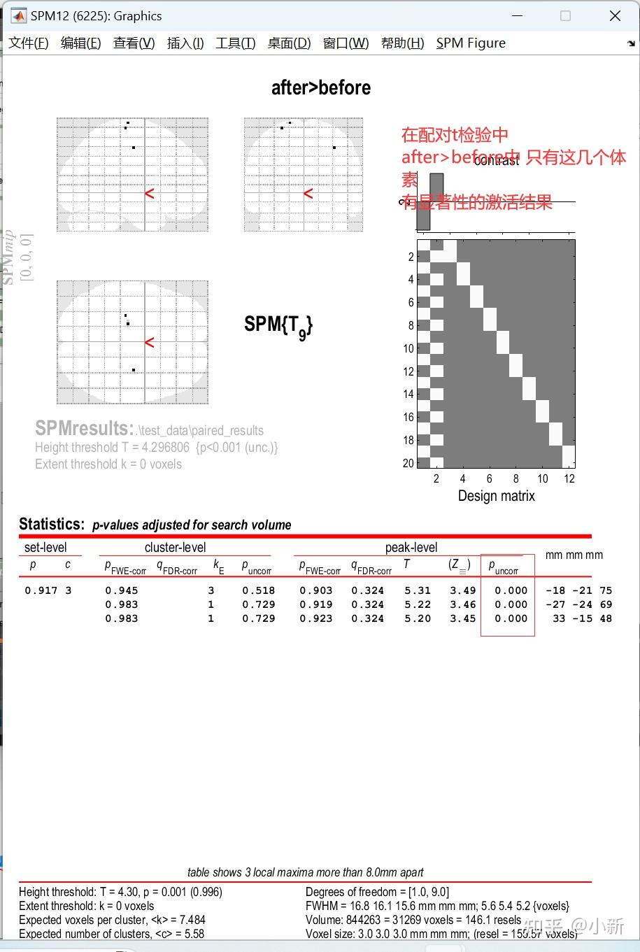 10-SPM-fmri任务态 二阶分析： 配对样本t检验 - 知乎