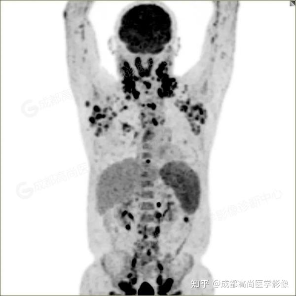 【高尚病例】全身多部位结核PET/CT显像一例 - 知乎