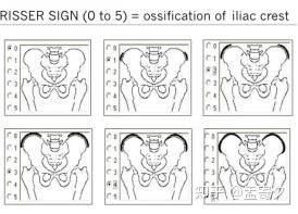 什么是Risser征？ - 知乎