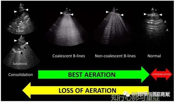 第149期 滴定PEEP的9个方法 - 知乎