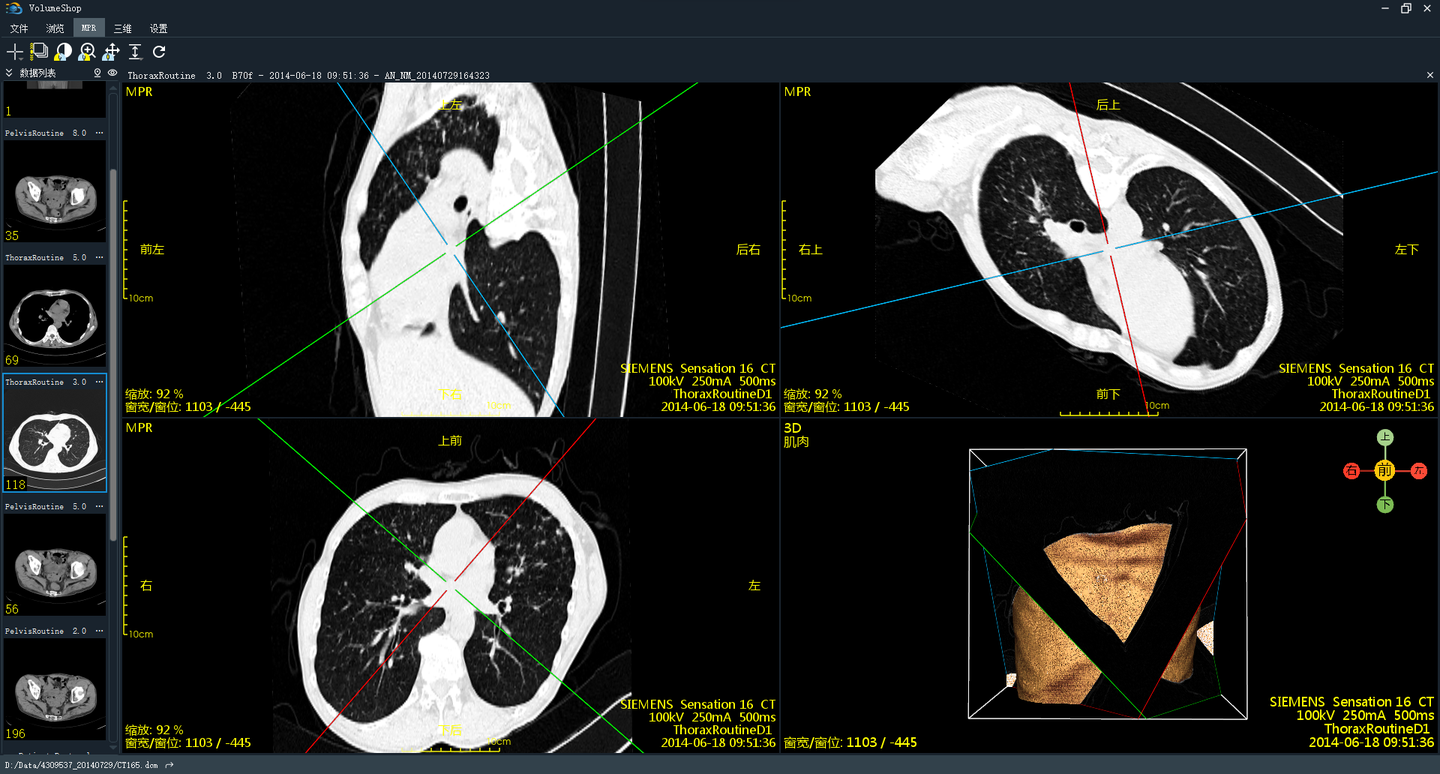 医学影像MPR（多平面重建）介绍 - 知乎