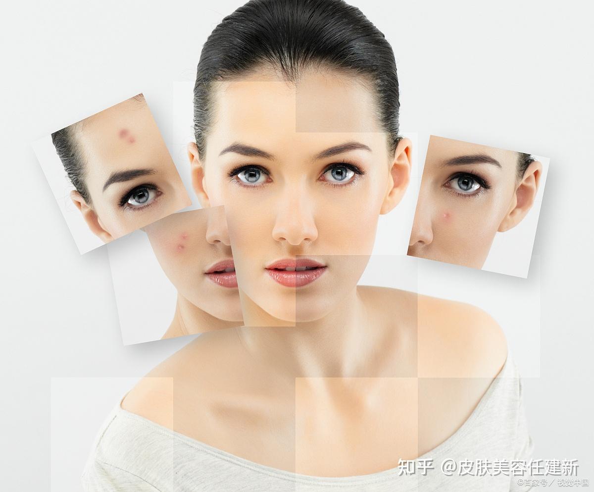 光子嫩肤间隔多久做一次? 知乎