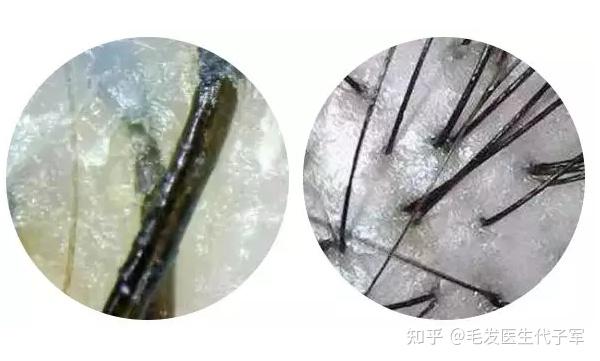 毛囊检测到底有什么用？ 知乎 8157