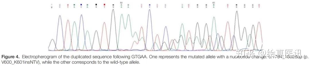 PCR检出BRAF V600E“误诊”甲状腺乳头状癌，病理确诊甲状腺滤泡癌同时检出罕见BRAF突变 - 知乎