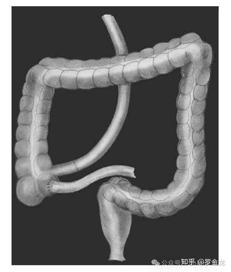 减重代谢手术的发展及历史演进 - 知乎