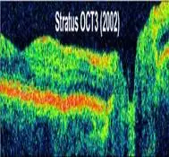 医疗器械技术解析- 什么是OCT - 知乎