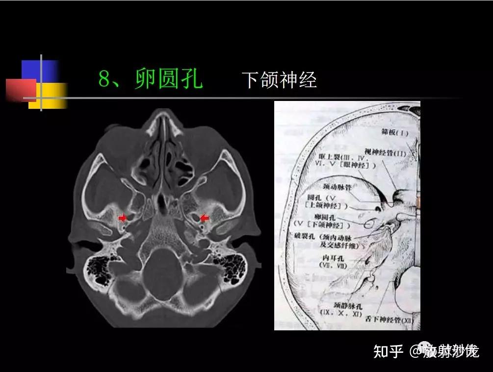 收藏必备 鼻咽部的ct详细解剖 知乎