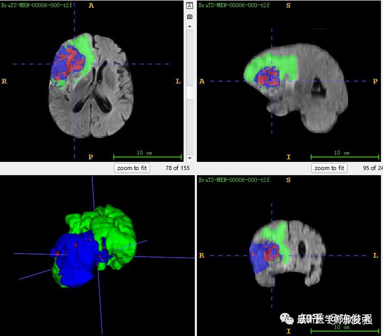 BraTS2023-MEN——BraTS2023颅内脑膜瘤分割挑战赛 - 知乎