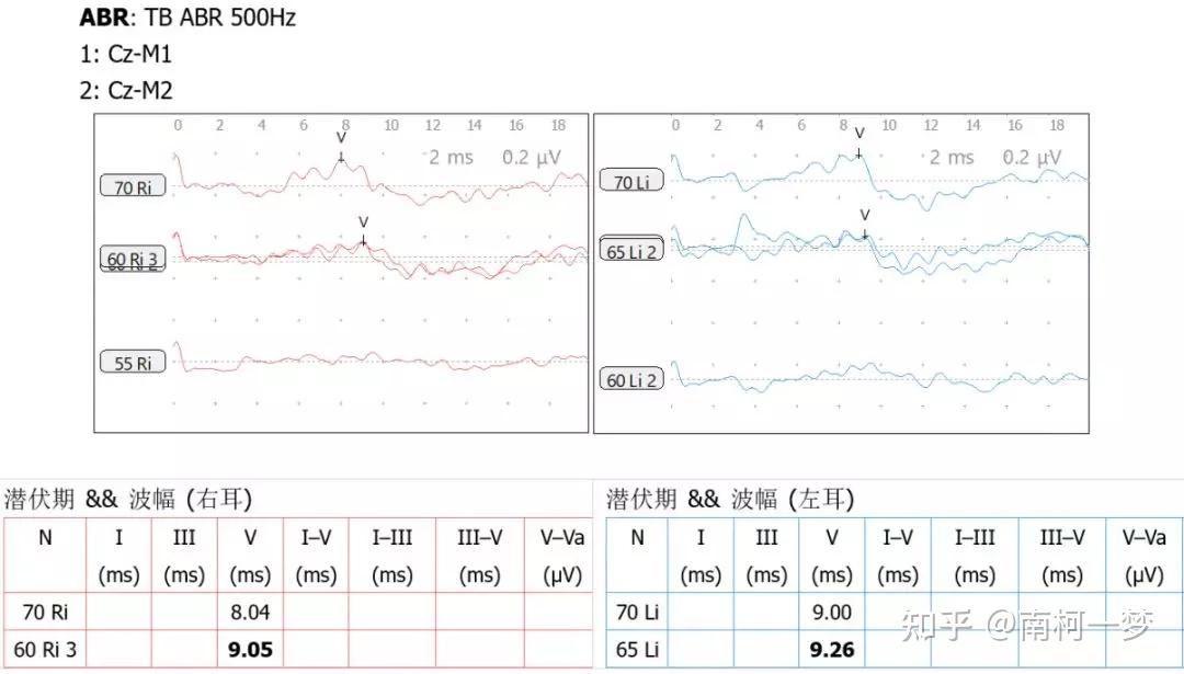 如何看懂电生理报告？（ABR篇） - 知乎