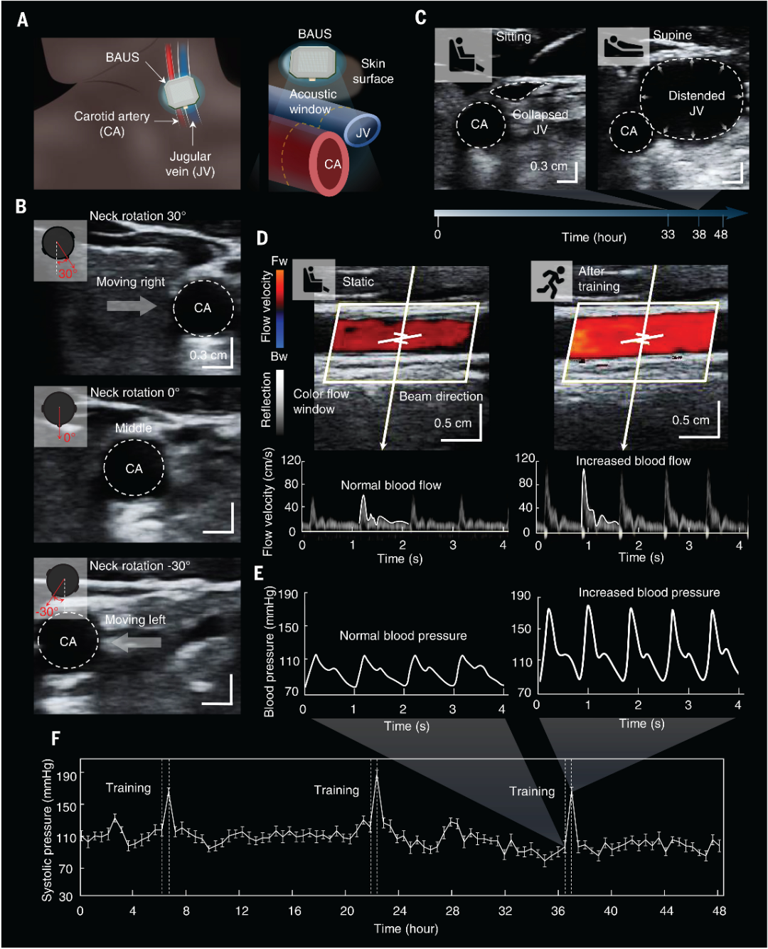 《Science》麻省理工学院赵选贺：生物粘附水凝胶/弹性体超声贴片，实现长期连续成像！ - 知乎