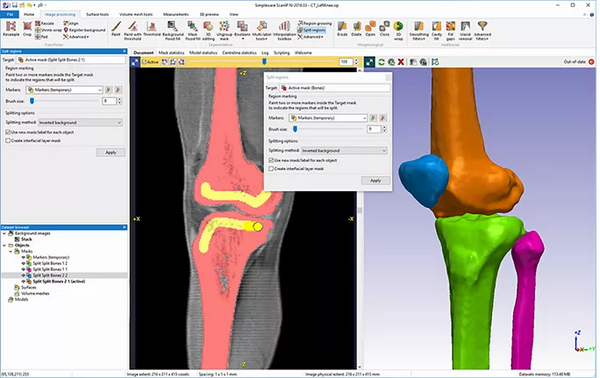 【Simpleware】患者个性化手术导板制作过程中的自动分割和设计工作流 - 知乎