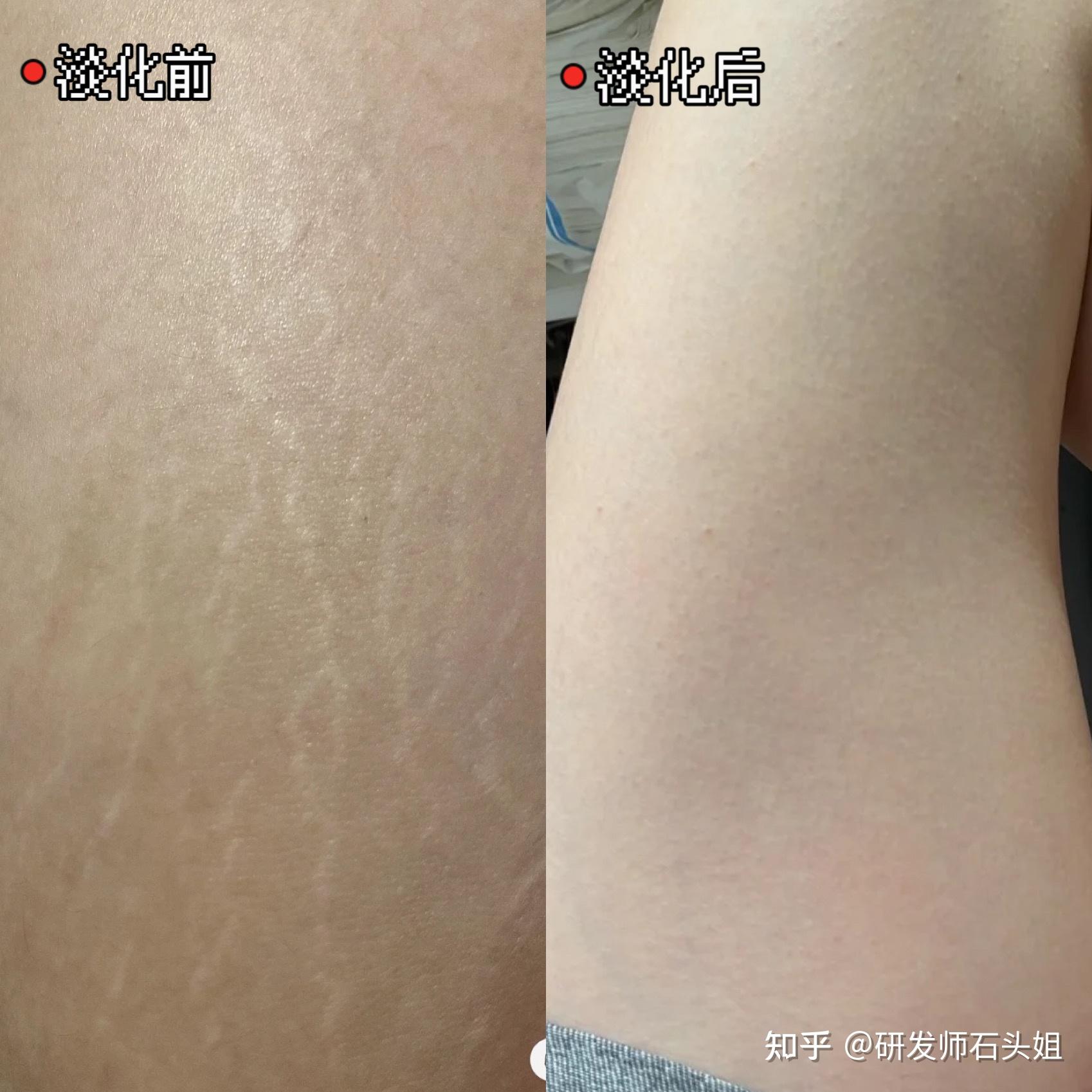 每天坚持这样做,居然能淡化肥胖纹?有些淡化肥胖纹的偏方千万别用! 知乎