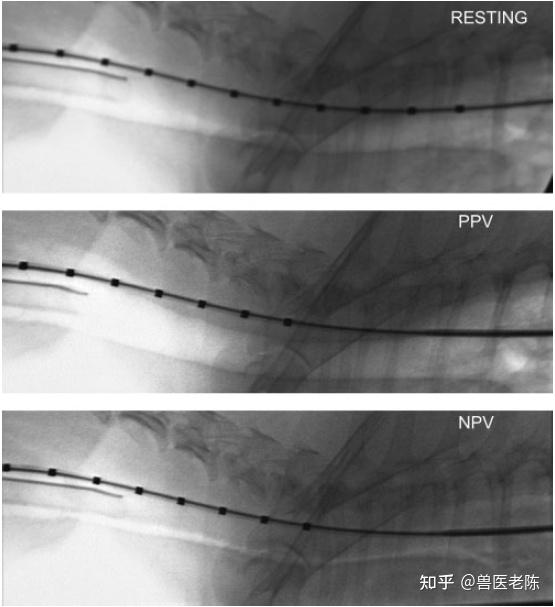 气管内支架 Intraluminal Tracheal Stenting - 知乎