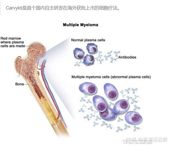 香港迈极康 | Carvykti日本获批上市，用于治疗多发性骨髓瘤 - 知乎