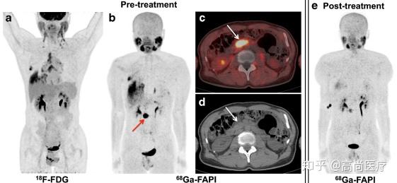 助力新药研发和临床诊疗的新型显像剂——68Ga-FAPI-04的合成与实验研究 - 知乎