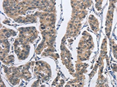 DSG2：桥粒芯蛋白家族DSGs表达最广泛的成员，心肌病、腺病毒和肿瘤新兴靶点？ - 知乎