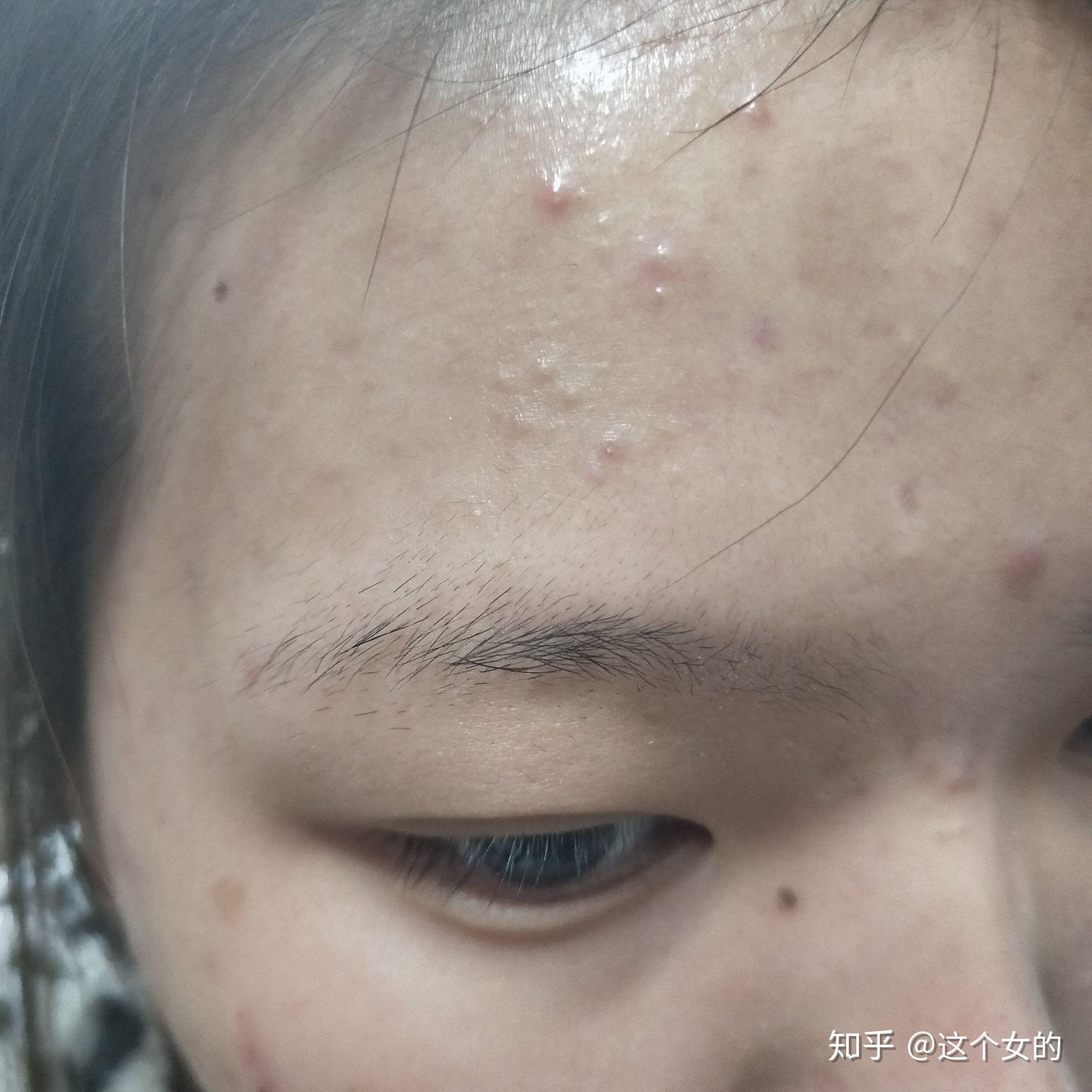8年中度痘肌抗痘之路主要服用异维a酸)持续记录更新中 知乎