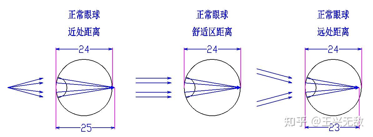 近视能恢复吗？ - 知乎