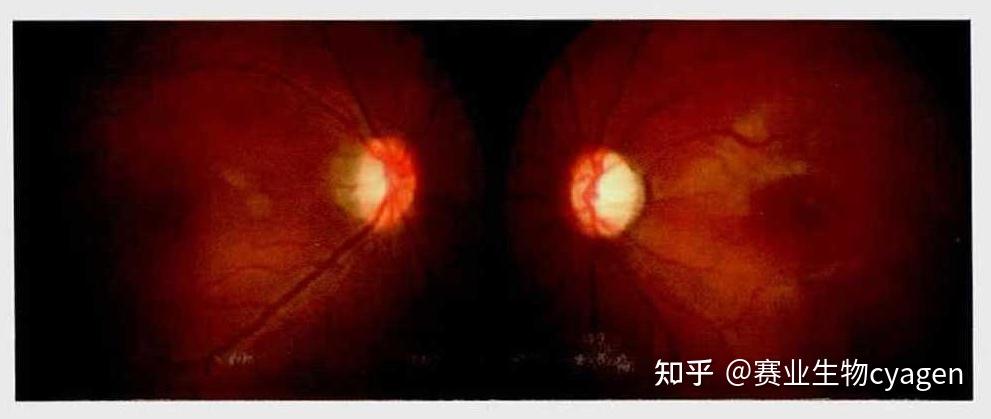 【罕见病并不罕见】Leber遗传性视神经病变的诊断与治疗 - 知乎