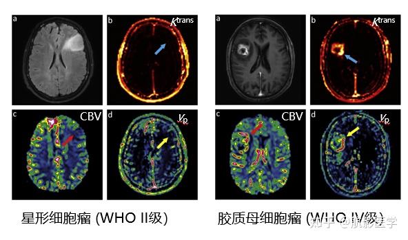 DCE-MRI (Dynamic Contrast-Enhanced Magnetic Resonance Imaging ) 动态对比增强磁 ...