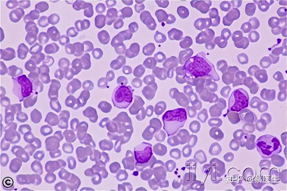 接吻病是什么？一接吻就得病吗？隐藏在背后的罪魁祸首终被找到！ - 知乎