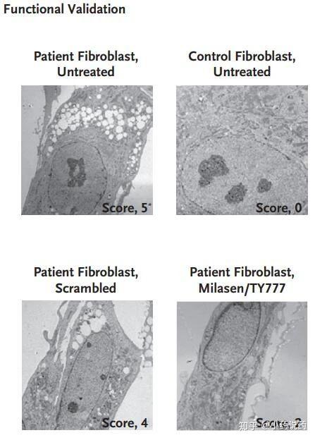小药说药药物篇-为一个人研发的药物：“Milasen” - 知乎