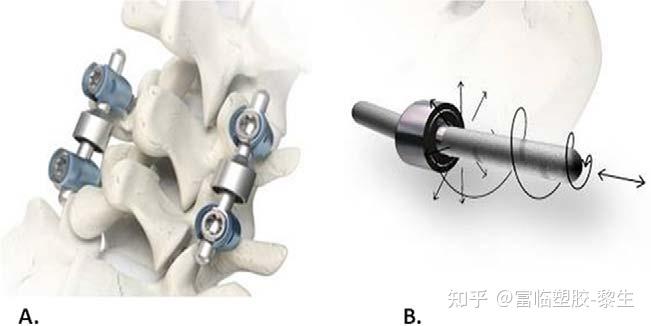 基于椎弓根螺钉的退行性脊柱后部动态稳定器Dynesys： 体外生物力学测试和临床结果 - 知乎