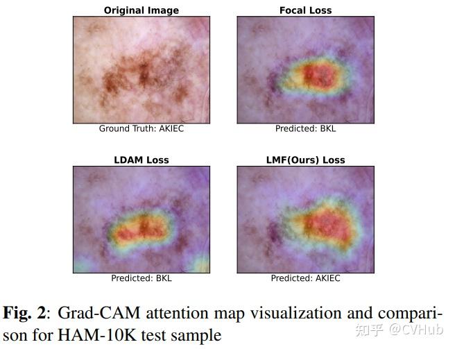 Focal Loss 后继之秀 | LMFLOSS：专治解决不平衡医学图像分类的新型混合损失函数 - 知乎