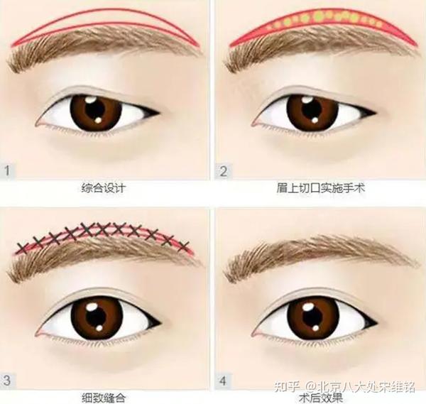 想做提眉切眉手术，这7个问题你一定得清楚 知乎