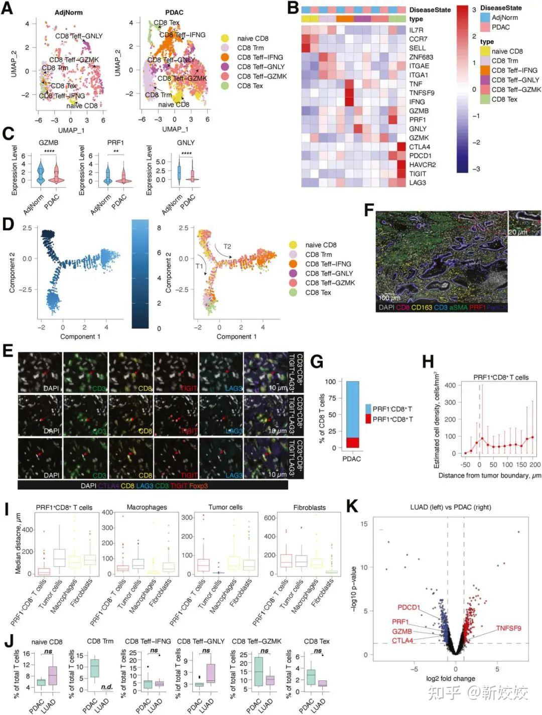 Gastroenterology（IF 33.883）| 单细胞转录组+空间转录组+多色免疫荧光揭示胰腺癌的免疫功能障碍机制 - 知乎