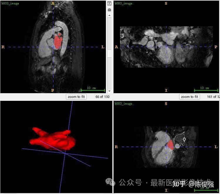 Left Atrial Segmentation Challenge 2013——MRI图像中的左心房分割 - 知乎