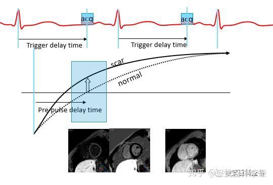 心脏磁共振技术大全（六） - 知乎