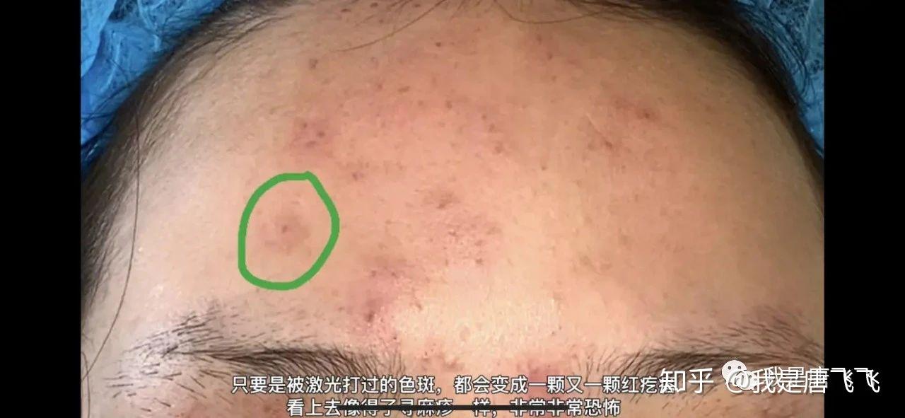 我去做超皮秒了，手术过程和30天恢复记录分享【整容】【医美】 知乎