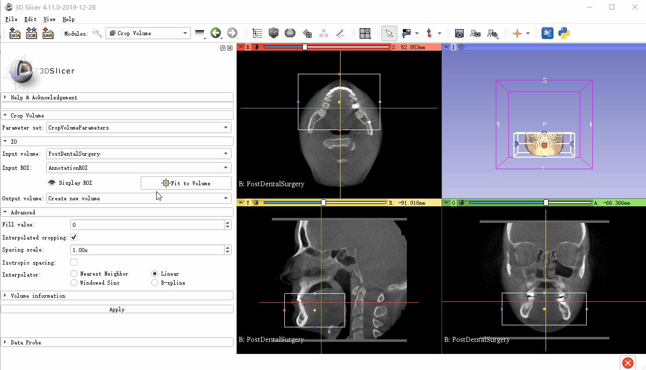 3D Slicer——选择感兴趣区，输出为DICOM序列 - 知乎