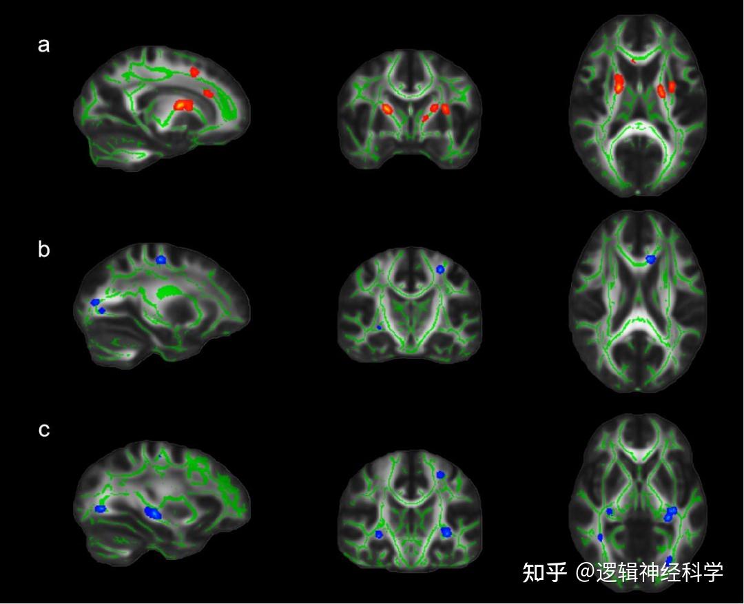 J Neurol︱特发性震颤患者脑微结构改变及其与临床特征的相关性：一项弥散峰度成像研究 - 知乎
