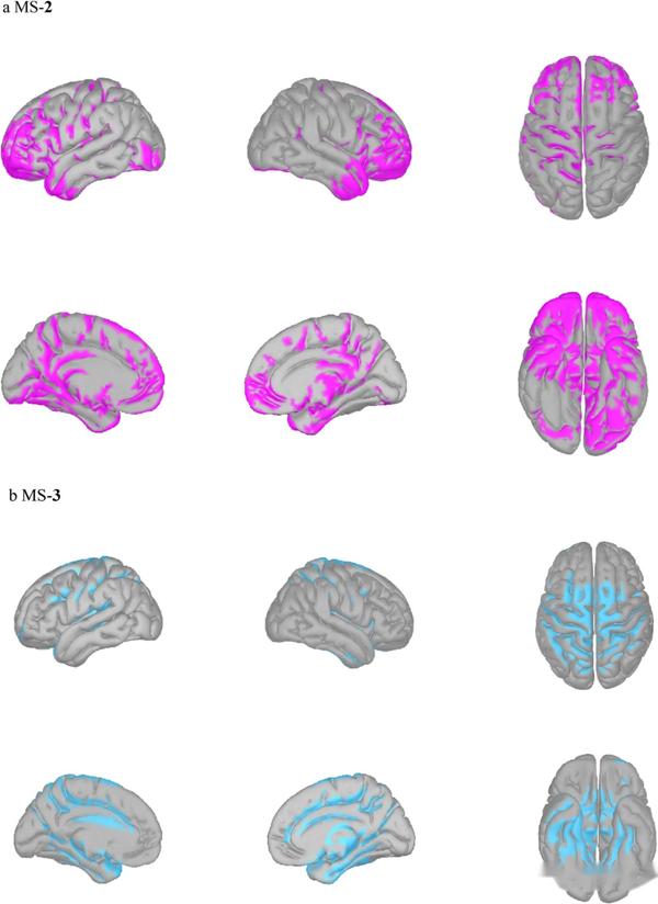 抑郁症治疗 | 经颅磁刺激后EEG神经网络的大规模变化 - 知乎