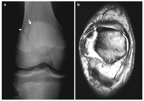 髌骨分裂磁共振表现 - 知乎