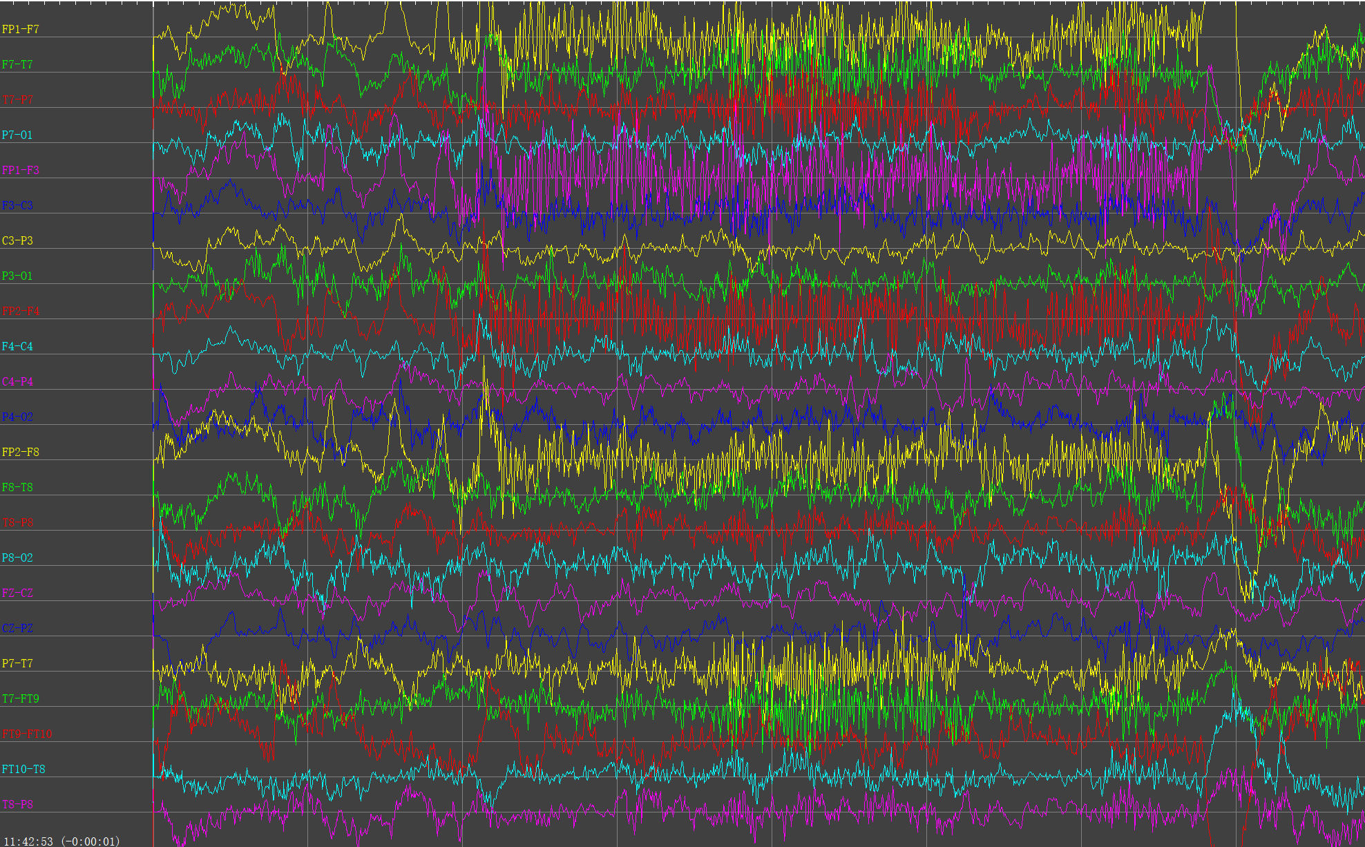 EDF文件介绍 以CHB-MIT数据集为例 - 知乎